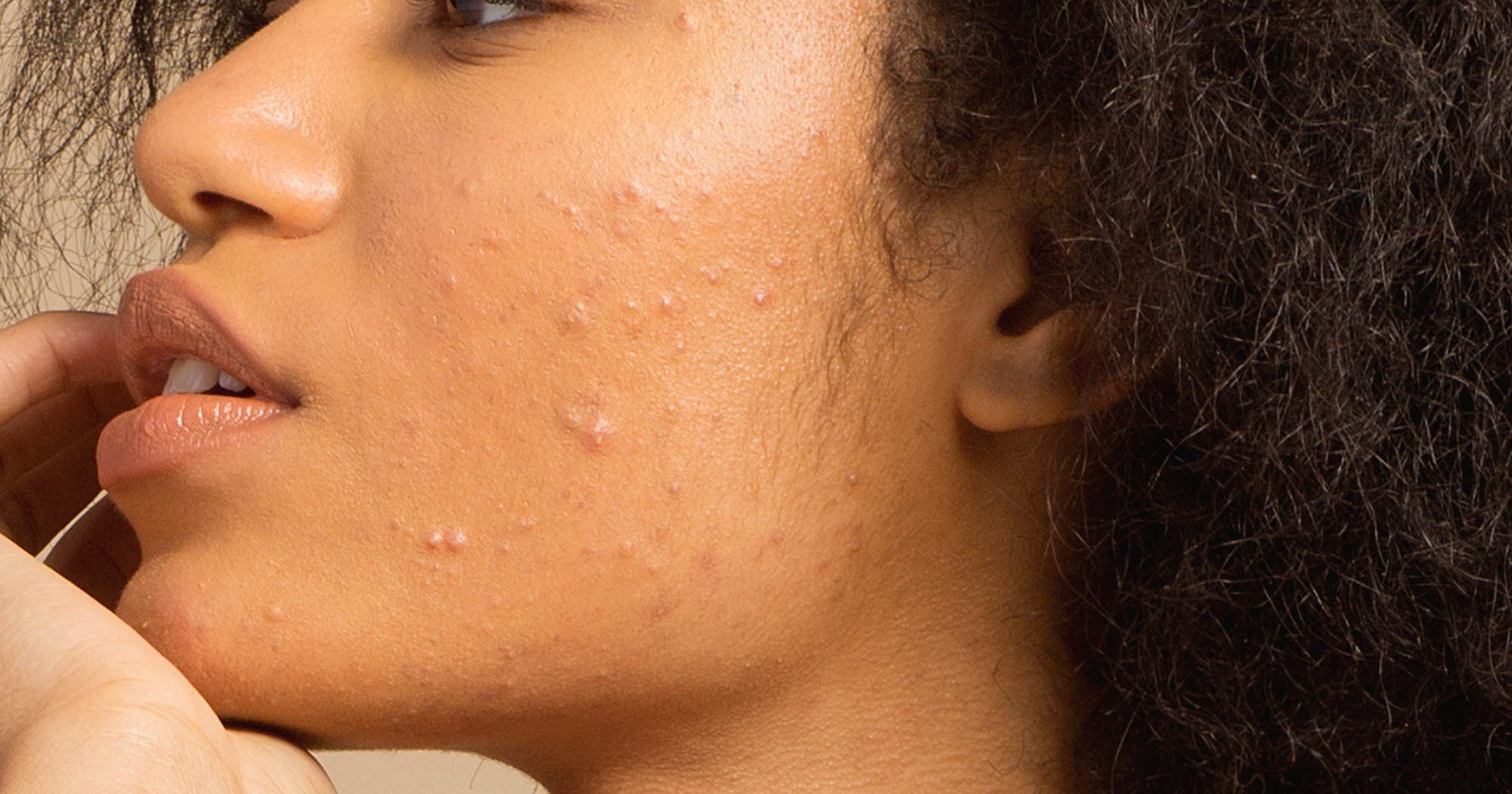 Acne Advertising - Acne Shaming