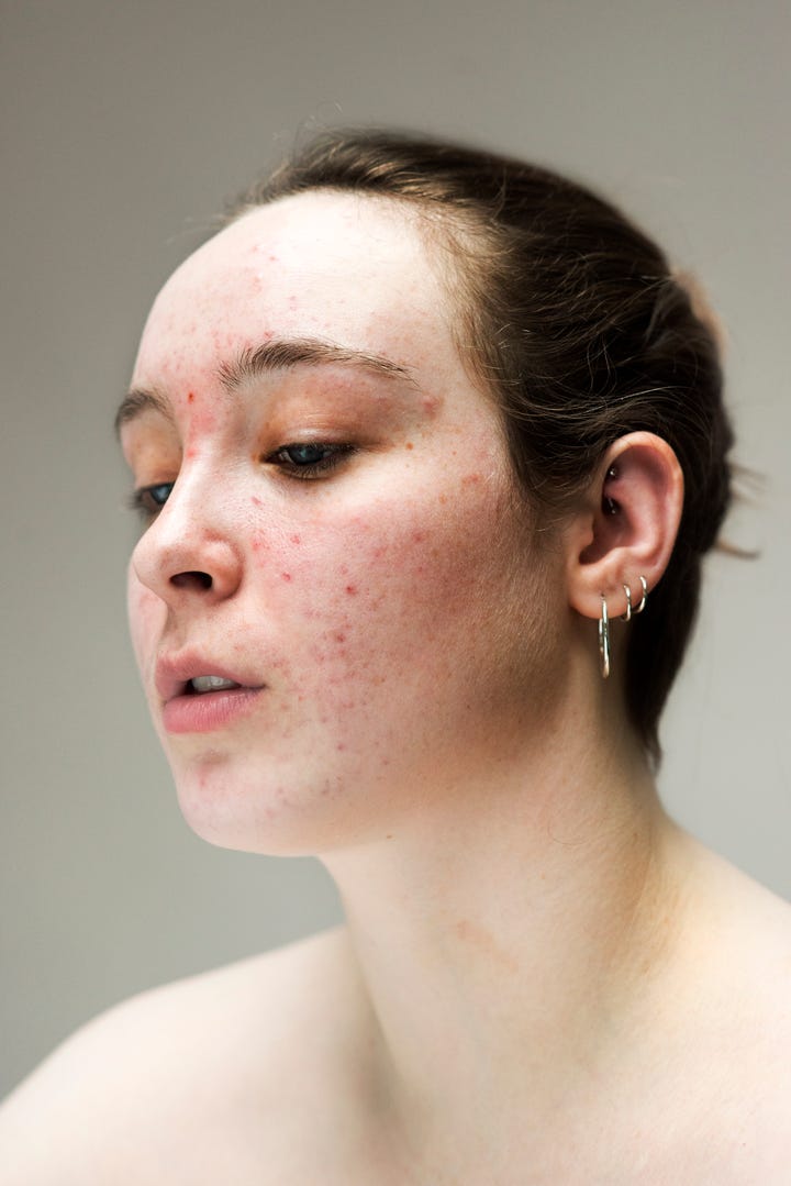 #FlawedSkin: Raw photos of women with common skin conditions | The ...