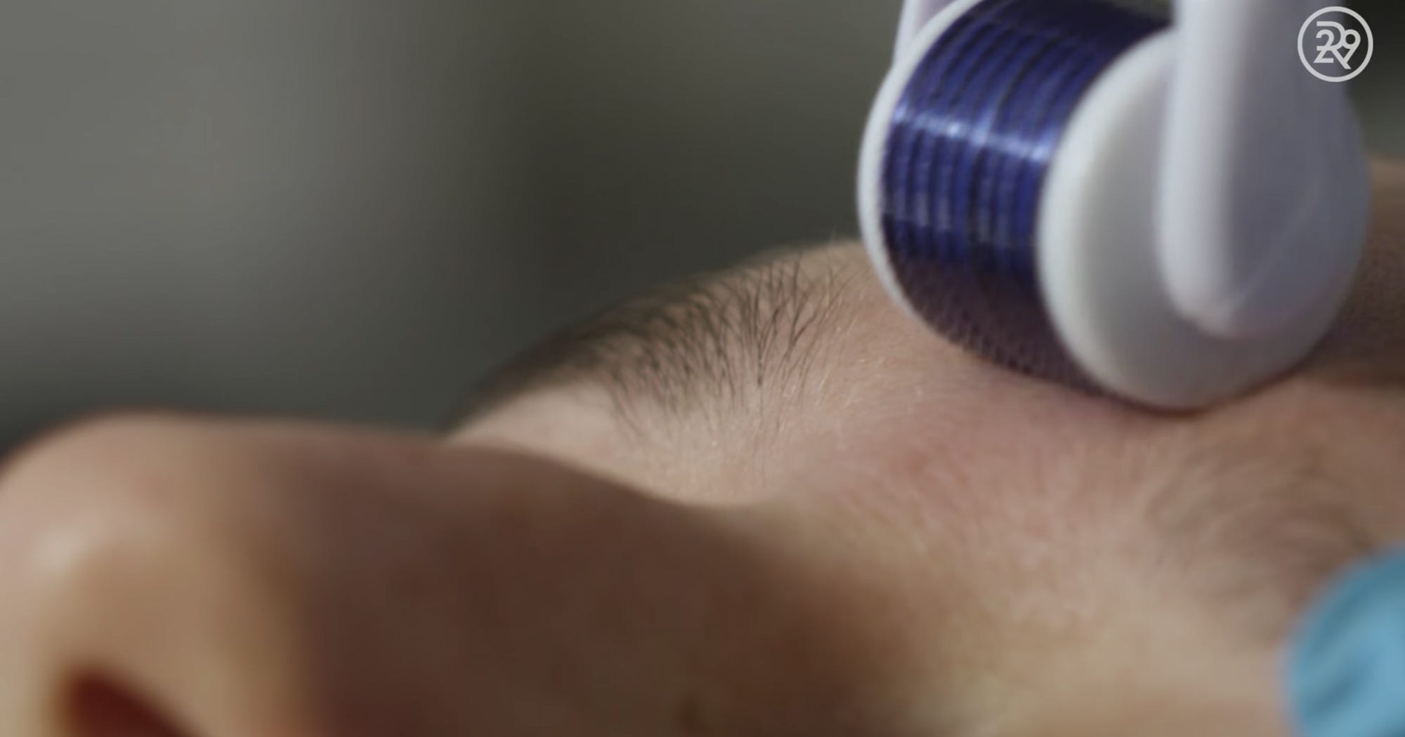 Micro Needling Skin Treatment What Is Dermarolling