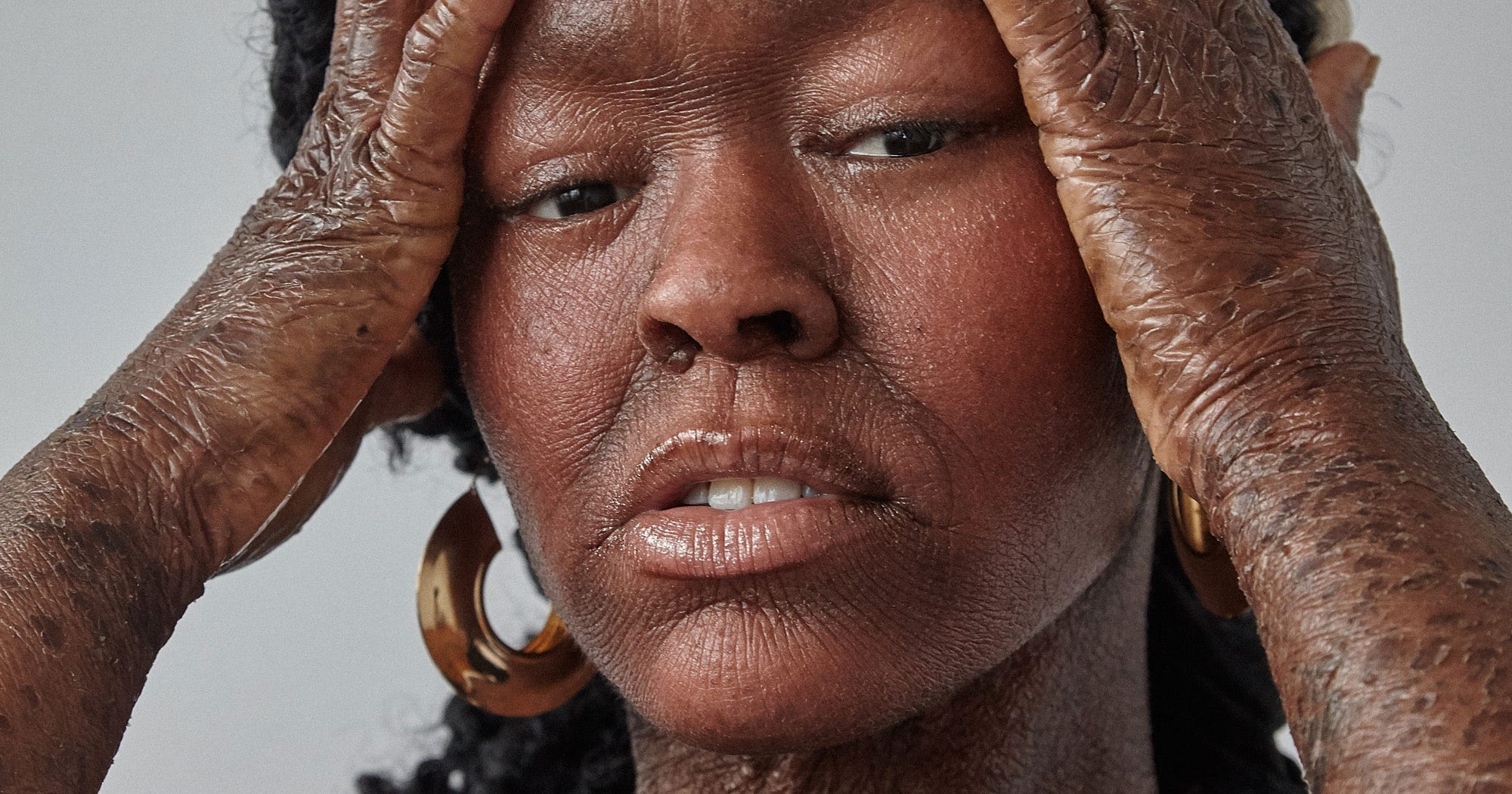 Meine seltene Hautkrankheit inspirierte mich zum Modeln