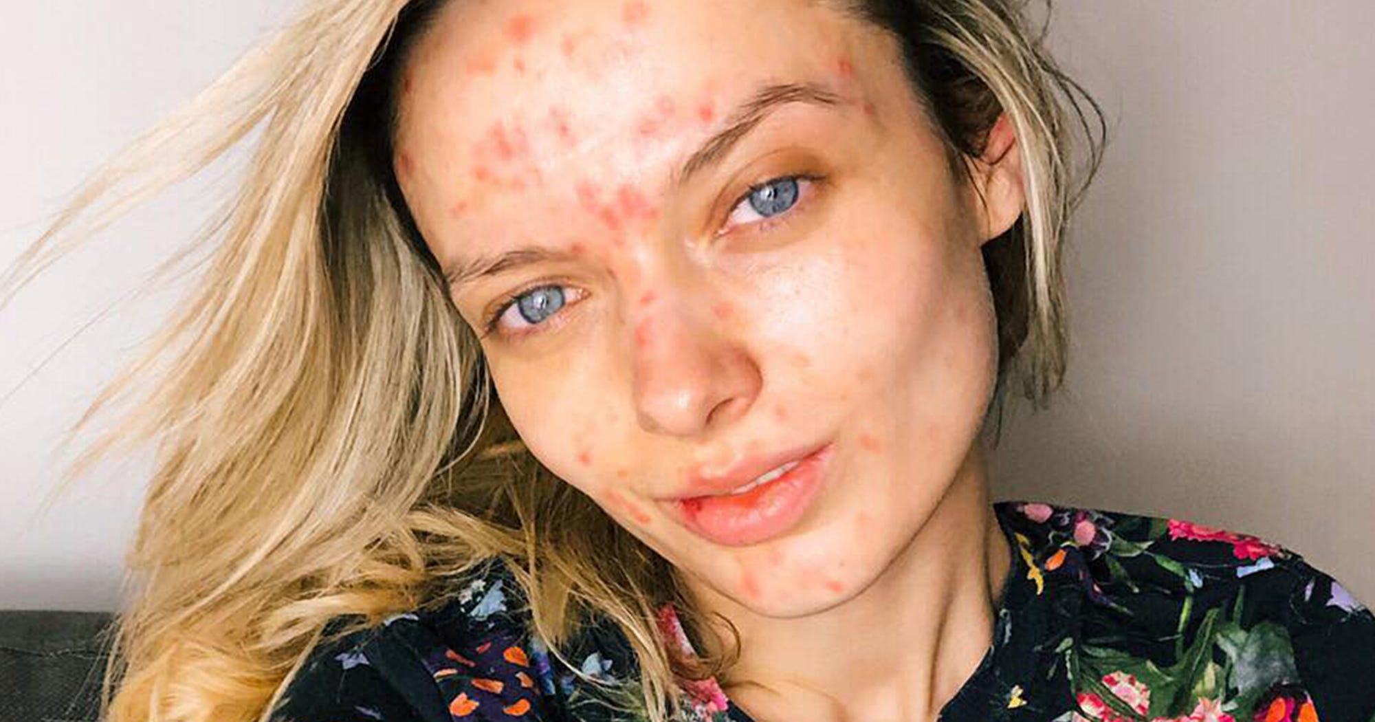 Huda Beauty & My Pale Skin Battle Over Acne Scars