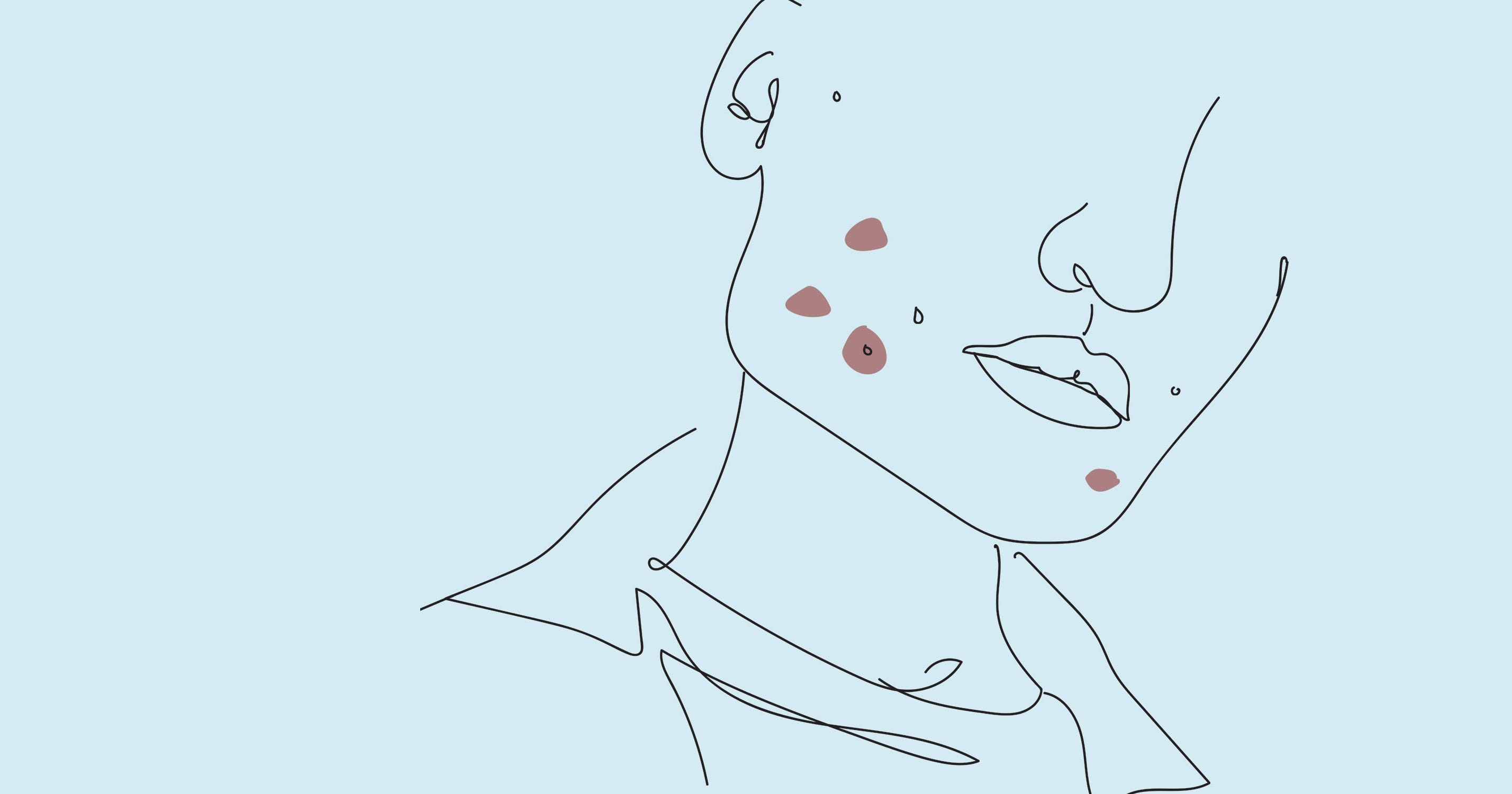 How To Fade Red Marks & Pigmentation After Acne