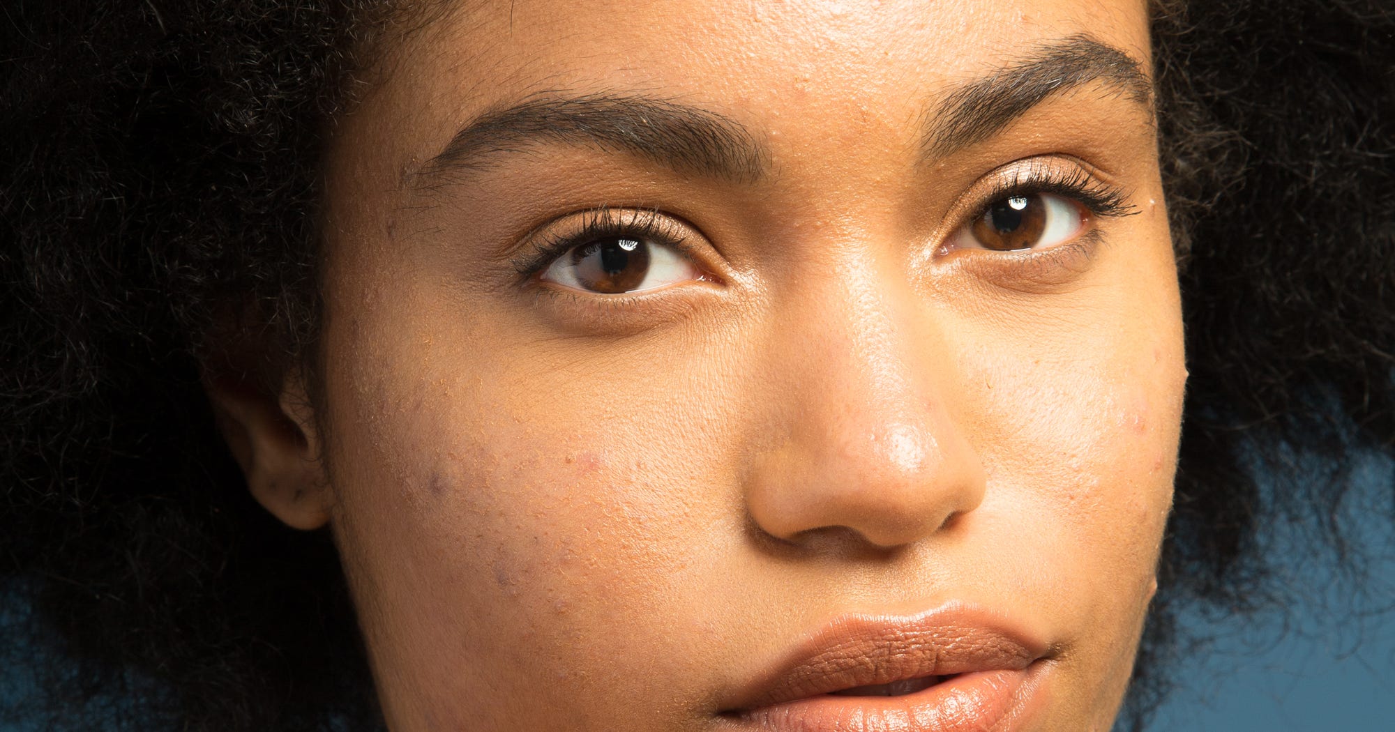 New Acne Treatments - Acupuncture, Turmeric, Crystals