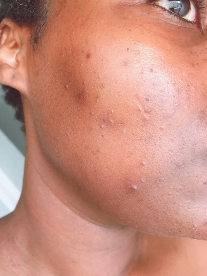 Skin Blemishes During Menstrual Cycle Period Skincare Guide See